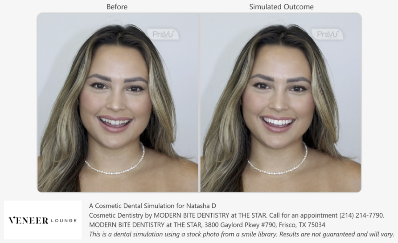 What to Expect When Getting Veneers | Veneer Lounge